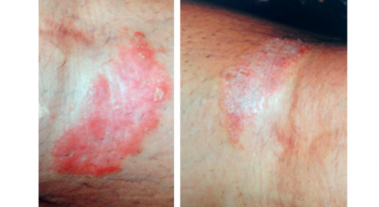 Psoriasis in Calgary, Alberta | Nardella Clinic